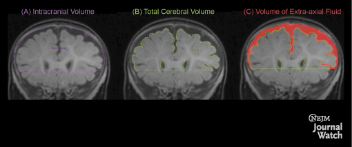 A Brain Marker for ASD in Very Young Children?