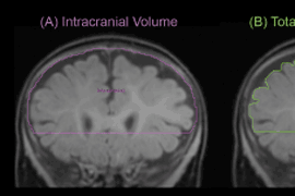 A Brain Marker for ASD in Very Young Children?