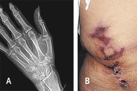 Calciphylaxis: A Large Case Series